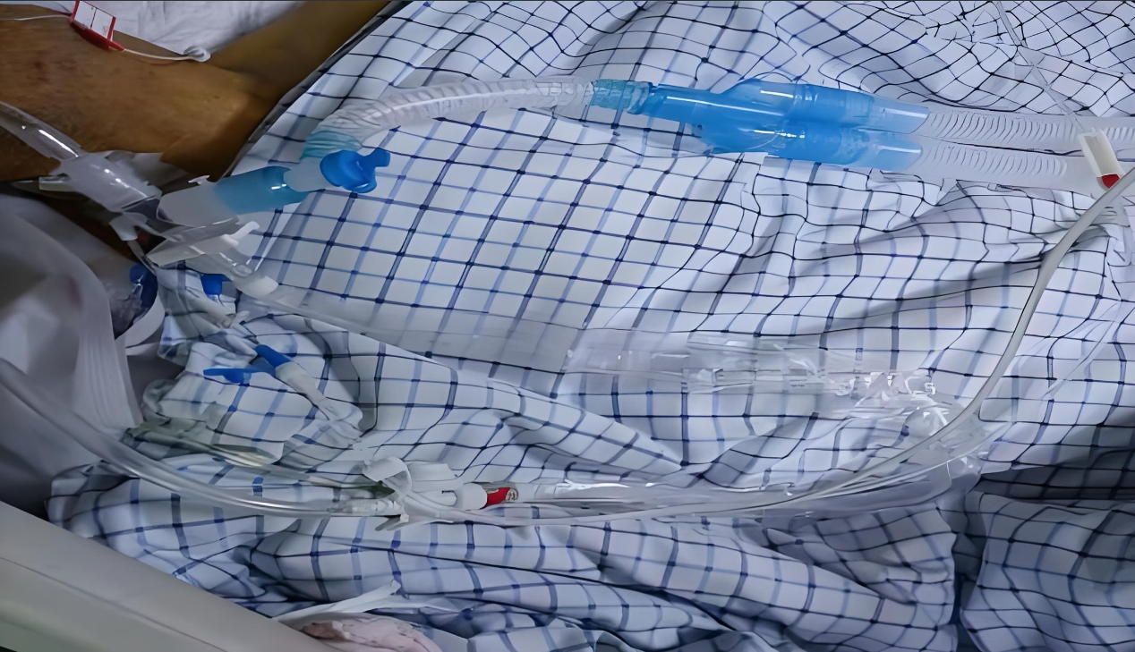 How To Use Closed And Inline Suction Catheter